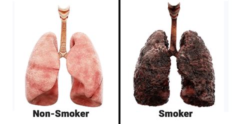 Smokers Lungs After Years My Xxx Hot Girl