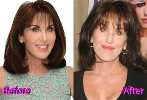 Robin Mcgraw Plastic Surgery Before And After Robin Mcgraw Plastic