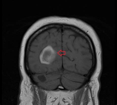 Mri Pathology Images Pathologies Mri Brain Pathology In 2025 Mri