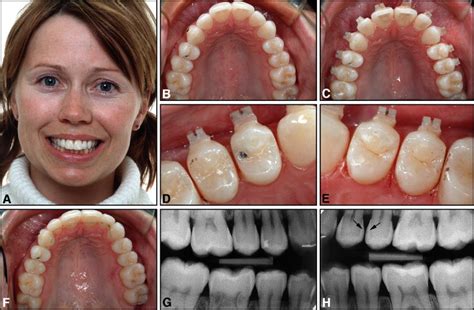 Dental Health Assessed After Interproximal Enamel Reduction Caries Risk In Posterior Teeth