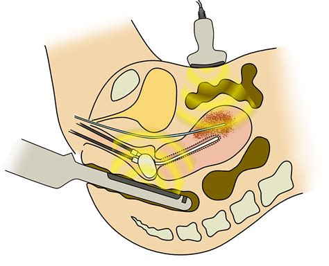 Frontiers High Dose Rate Interstitial Brachytherapy For Deeply