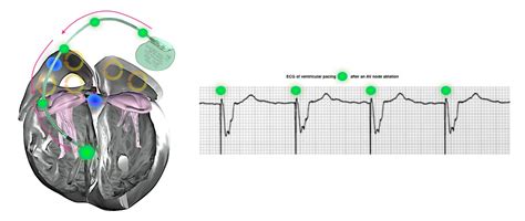Av Node Ablation One Heart Cardiology