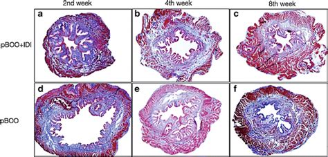 A In Pboo Idi Group Prominent Fibrosis Especially In Subepithelial