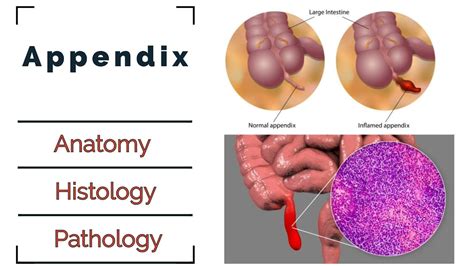 Appendix Acute Appendicitis Histology Pathology Youtube