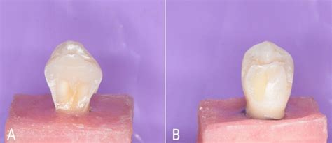 Fracture Pattern Assessment A Non Restorable Fracture B