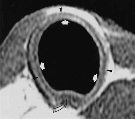 Tracheal Invasion By Thyroid Carcinoma Prediction Using Mr Imaging Ajr