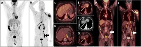 Diagnostic Performance Of Ga68 FAPI In Signet Ring Cell Carcinoma Stomach In Comparison To FDG