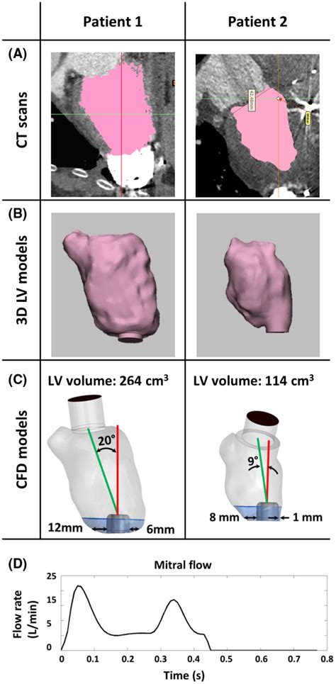 The Influence Of Left Ventricular Assist Device Inflow Cannula Position On Thrombosis Risk PMC