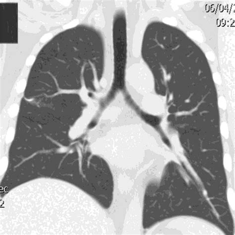 Ct Chest Coronal View Demonstrating Bilateral Diffuse Lung