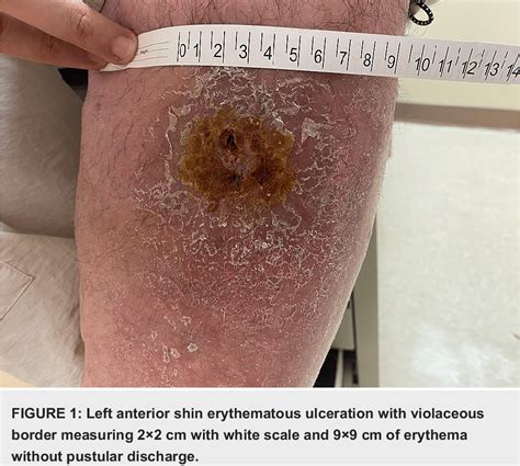 Figure 1 From Empiric Treatment Of Classical Pyoderma Gangrenosum In