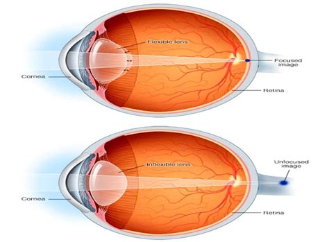 Understanding Presbyopia Optography