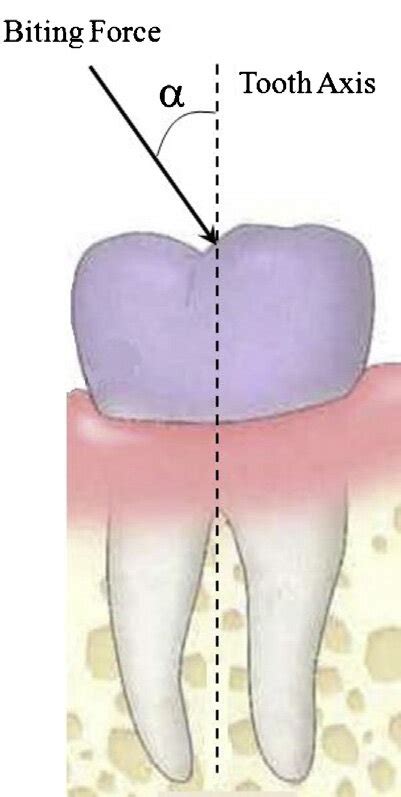 Biting Force Applied On The Crown Top Surface At Angle Misch 2007 Download Scientific Diagram