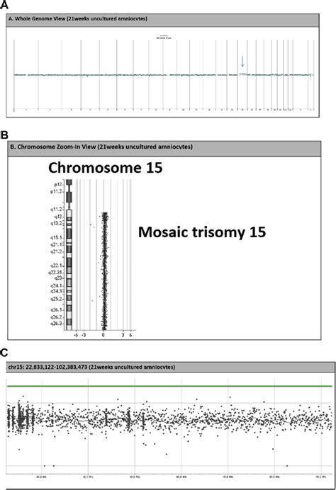 A B And C Array Comparative Genomic Hybridization Acgh Analysis
