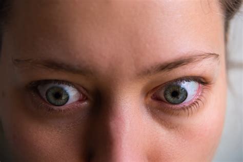 Thyroid Eye Disease Eagle Eye Aesthetic