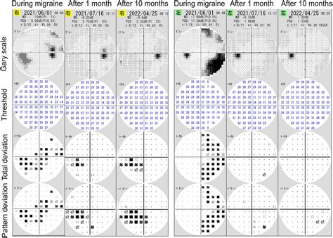 Glaucoma Vision Loss Pattern