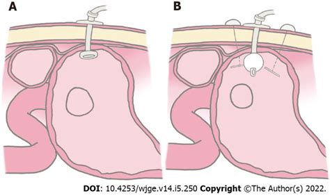 Percutaneous Endoscopic Gastrostomy And Jejunostomy Indications And