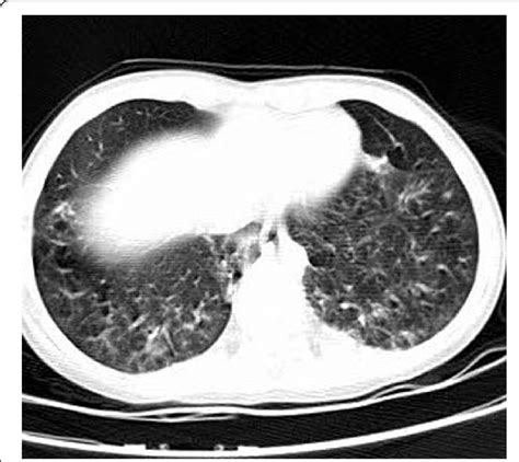 Interlobular Septal Thickening And Reticular Density In Both Lower Download Scientific Diagram