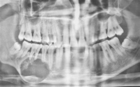 Orthopantomogram Showing Expansile Lytic Lesion In The Body Of Mandible