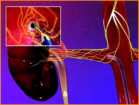 “renal Denervation Rdn Treatment” New Hope For Resistant Hypertension