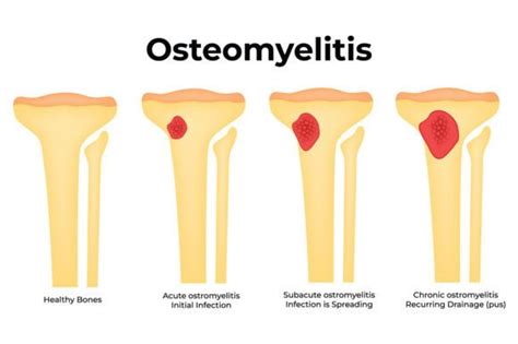 Osteomyelitis Science Design Vector Graphic By Hamjaiu · Creative Fabrica