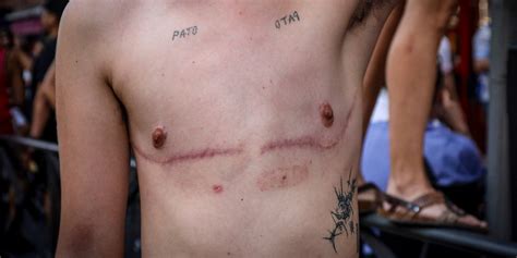 Healing After Top Surgery Expectation Vs Reality Autostraddle
