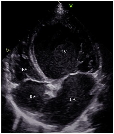 Myocarditis In Paediatric Patients Unveiling The Progression To