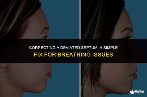 Correcting A Deviated Septum A Simple Fix For Breathing Issues Medshun