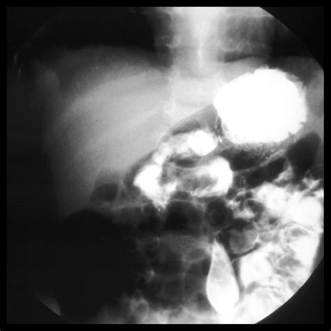 Newborn With Bilious Vomiting Pediatric Radiology Case Pediatric