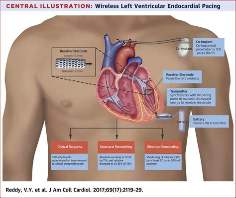 Cardiac Resynchronization Therapy With Wireless Left Ventricular