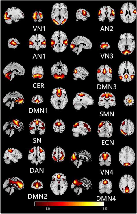 Abnormal Large Scale Neuronal Network In High Myopia Pmc