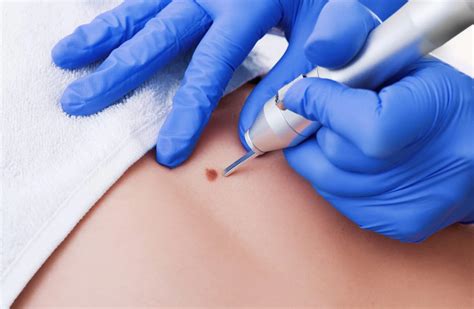 Skin Tag Removal For Sensitive Areas At Midas Wellness Hub Neck
