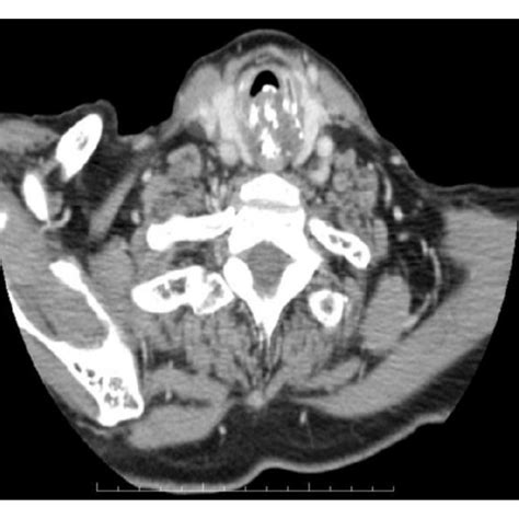 A Mass Is Seen In Subglottic Space Especially The Posterior Part With