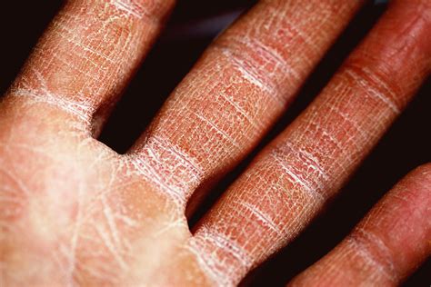 Mild Eczema On Back Of Hands