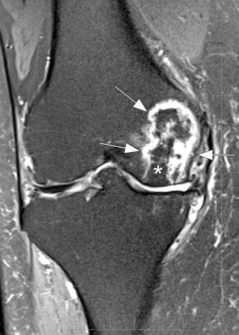 Intra Articular Corticosteroid Injections For The Treatment Of Hip And