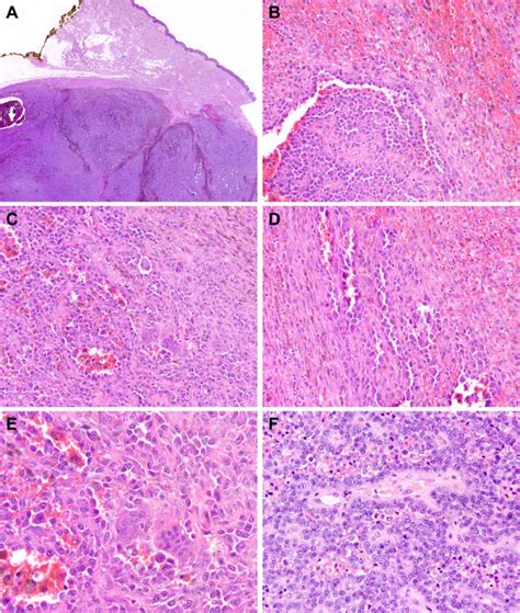 Extraenteric Malignant Gastrointestinal Neuroectodermal Tumor—a Clinicopathologic And Molecular