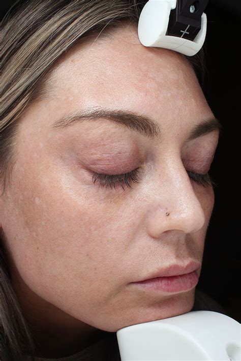 Moxi Before After Gallery Coachlight Clinic Spa