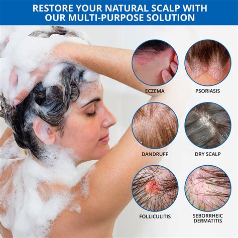 Eczema Hairline My Scalp Psoriasis Came Out Of Nowhere — Heres How