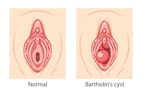 Bartholin Gland Cyst Operation