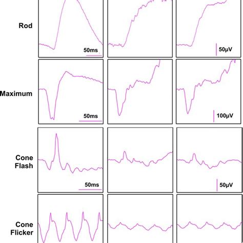 Electroretinogram Full Field Electroretinogram Results Performed Using Download Scientific