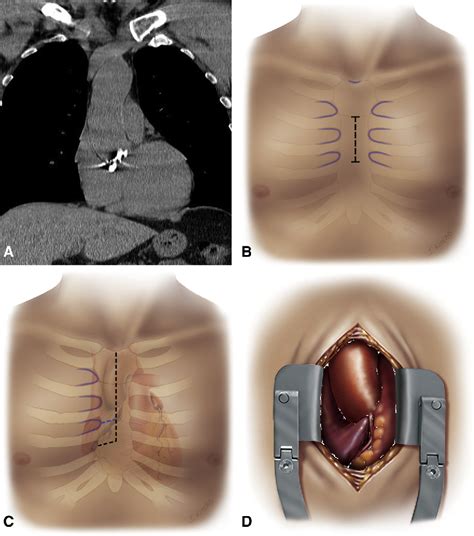 Figure 1 From Current Era Minimally Invasive Aortic Valve Replacement Techniques And Practice
