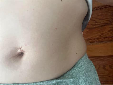 Anti Centromere Positive Rautoimmune