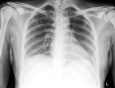 Normal Anteroposterior Chest Radiograph Download Scientific Diagram
