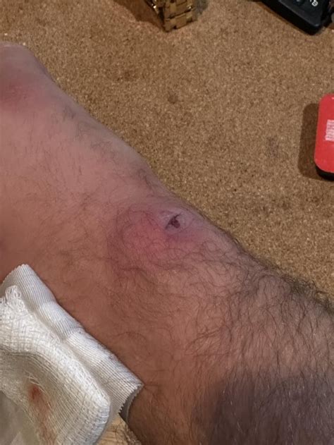 Drained Abscess Hand Swelling R Medical