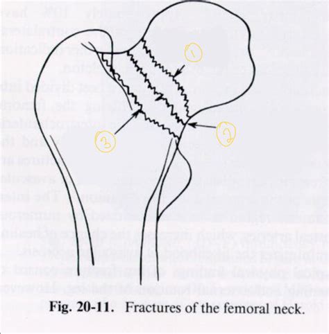 Part 10 Intracapsular Fractures Flashcards Quizlet