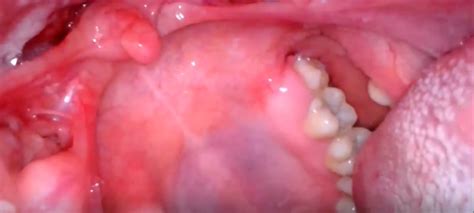 K M Reverse Endoscope View ThisVid Com