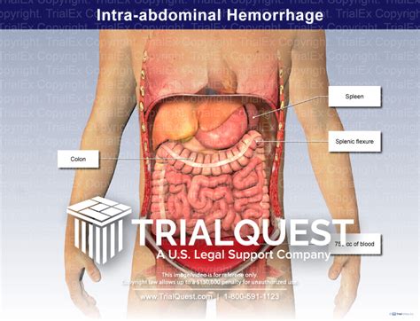 Intra Abdominal Hemorrhage Trialquest Inc