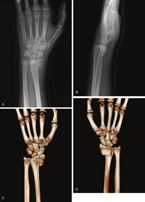 Initial Plain Radiographs A B And 3d Ct Reconstruction Images C D Download Scientific
