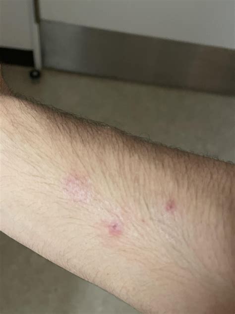 Rash Blistering And Really Itchy R Diagnoseme