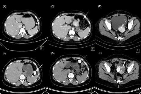 Comparison Of CT Images Dated September 2018 A C E With The Scan Download Scientific