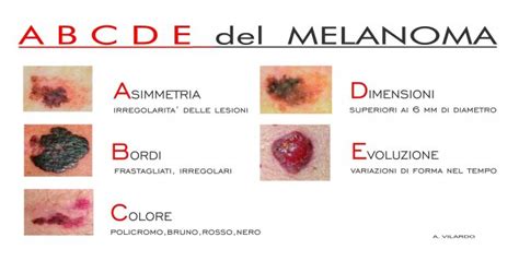 Quando E Come Controllare I Nei Nevi Antonella Vilardo Dermatologa